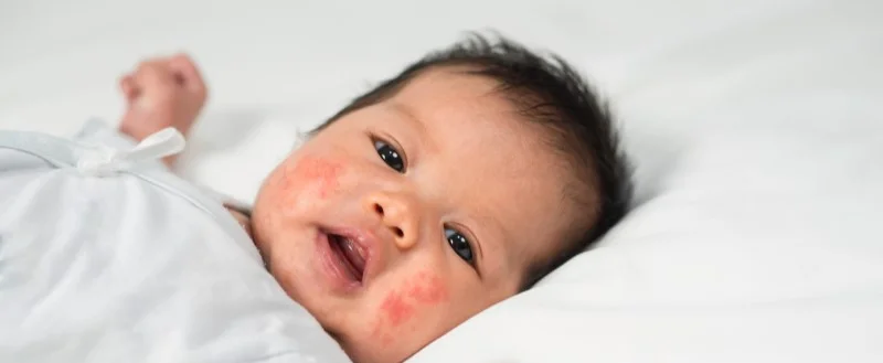 Alergi Susu Sapi pada Bayi: Penyebab, Ciri, dan Perawatannya